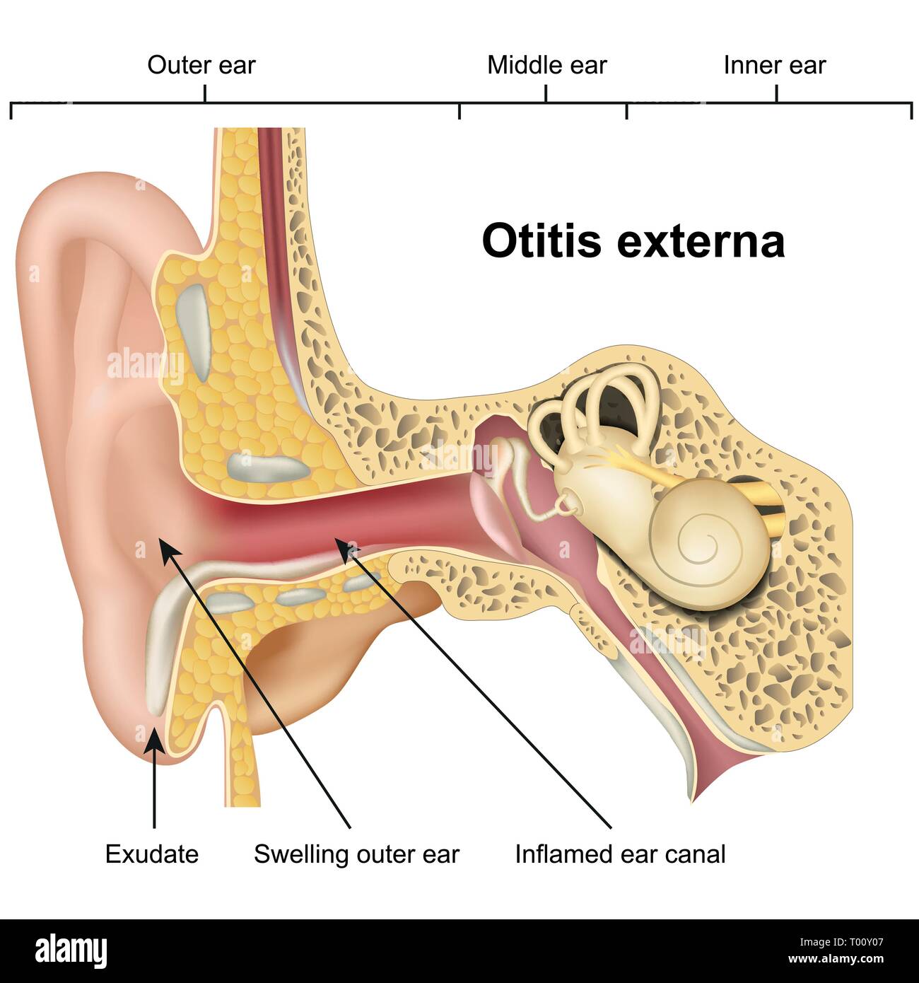 Malignant Otitis Externa? - Bissoy
